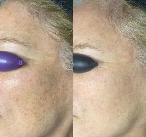 What Is BBL Laser Treatment?