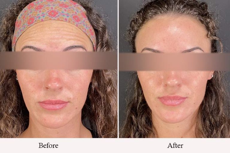 Preventative Botox - How Can It Help Prevent Wrinkles?