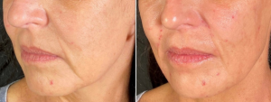 What Is a Botox Smile Lift? Procedure, Results, Aftercare