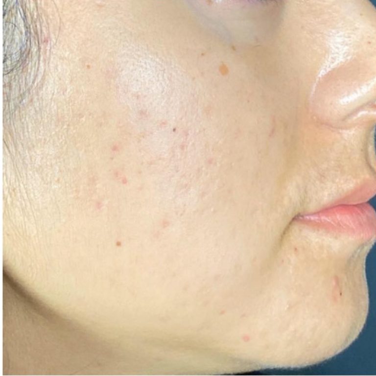 Types of Acne Scars & How to Treat Them