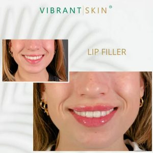 Dermal Fillers: What They Are, How They Work & More