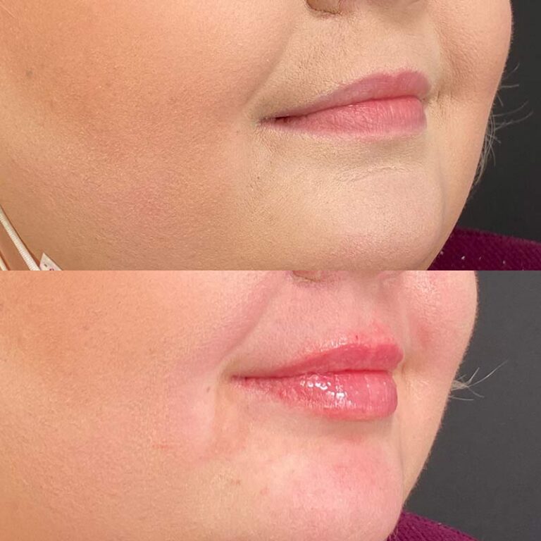 Versa Filler: Uses, Benefits, Procedure, and Results